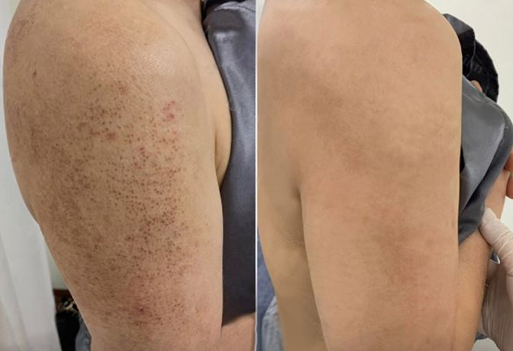 Viêm Nang Lông Ở Tay - Dấu Hiệu Và Cách Điều Trị Dứt Điểm